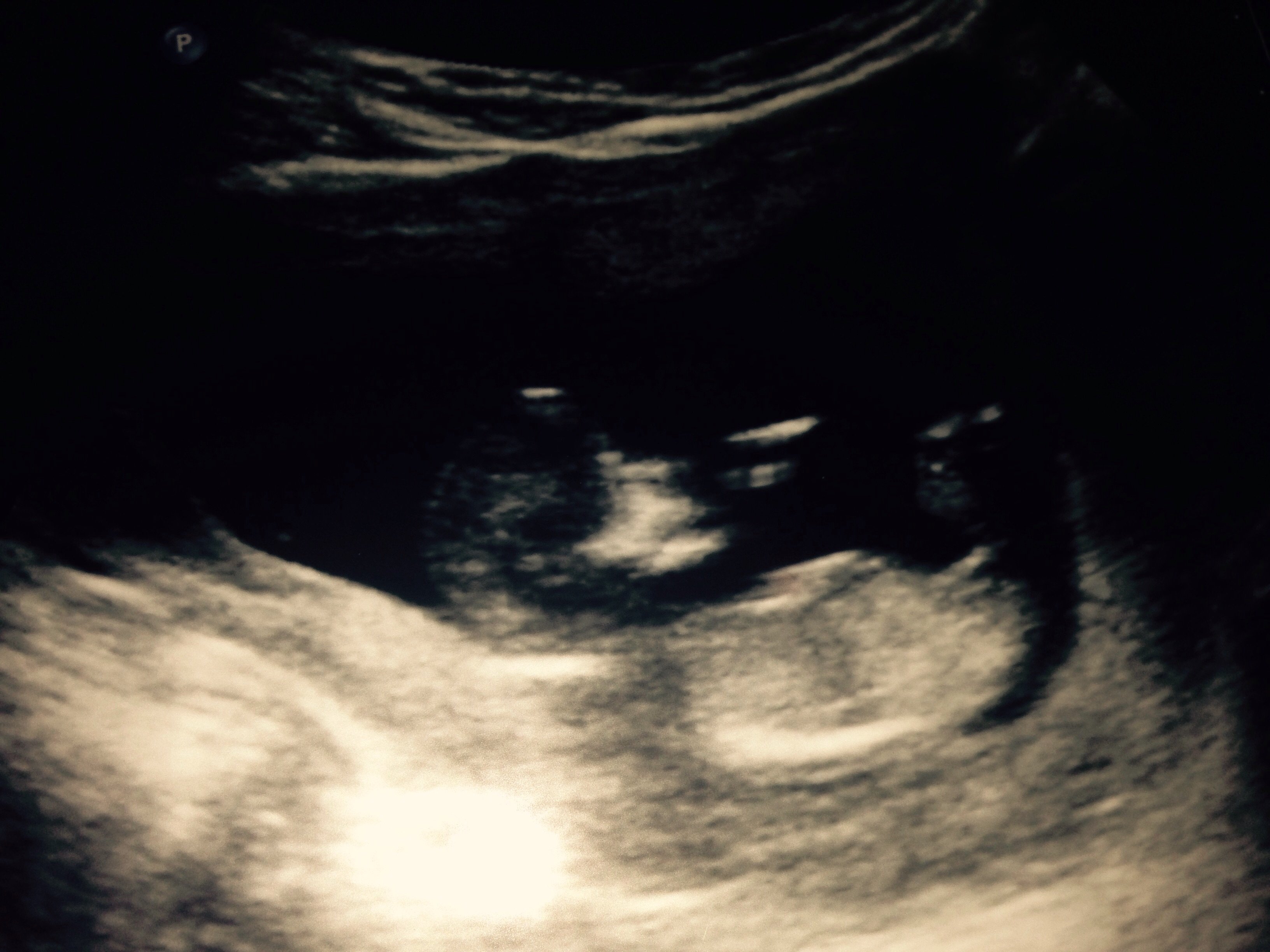 Gender 13 week scan — The Bump