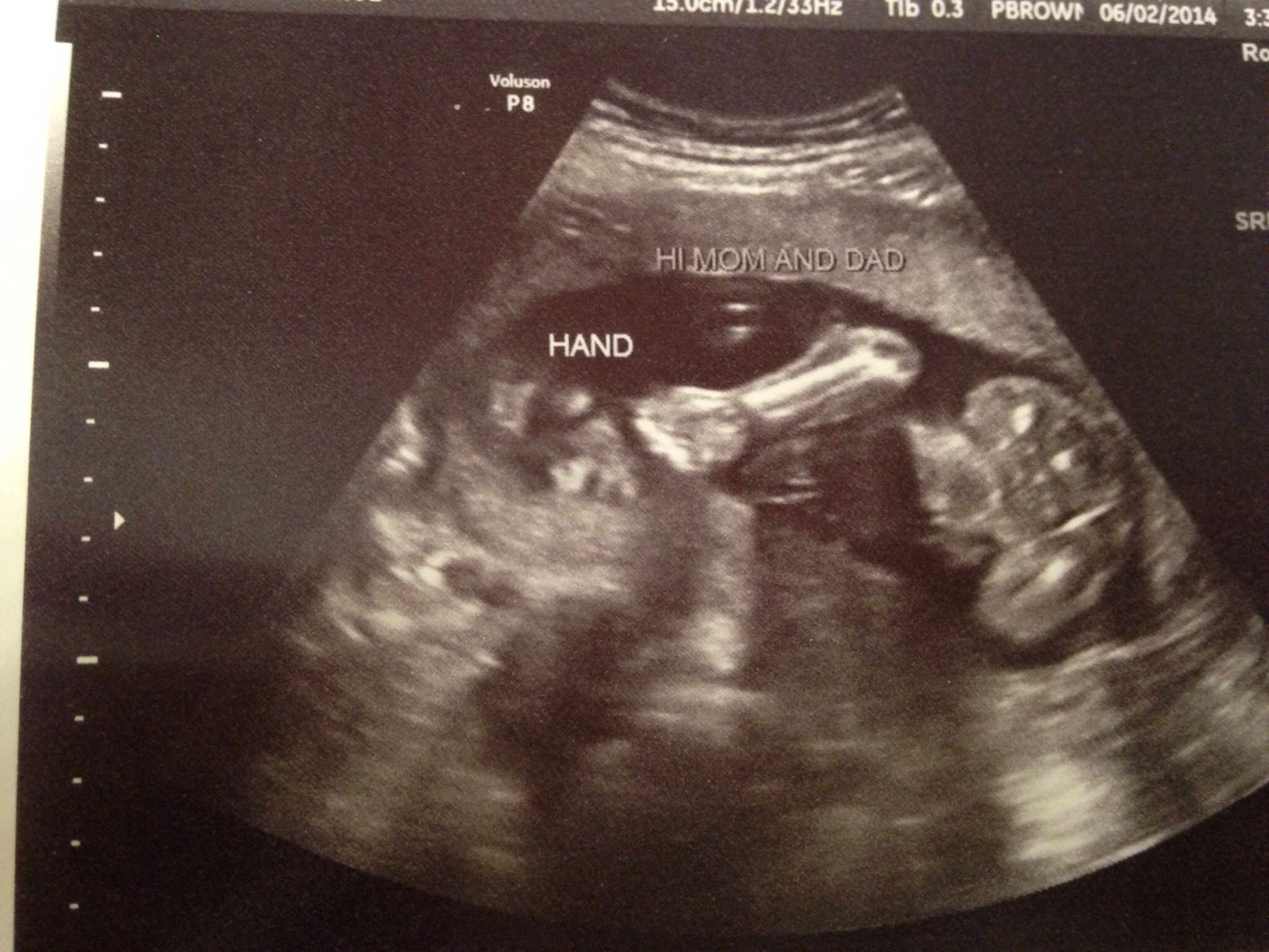 Anatomy scan and gender reveal!!! — The Bump