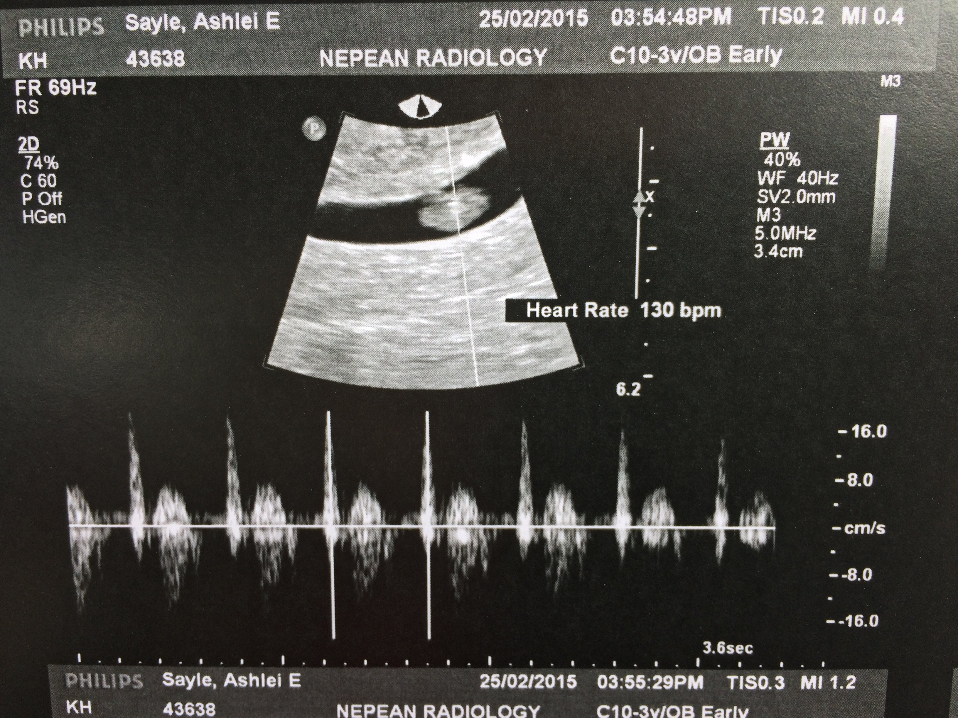 Sonogram at 8w4d. Now 9 weeks! — The Bump