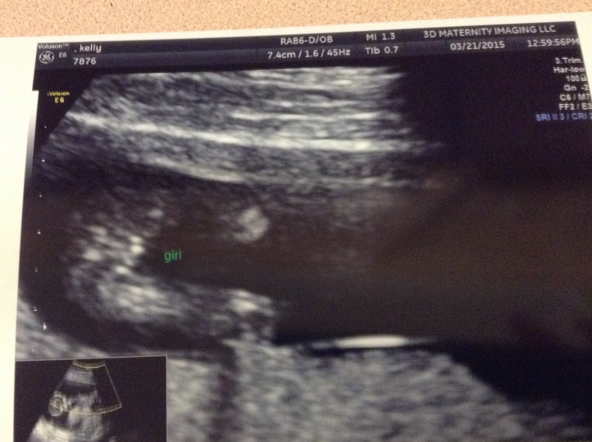 Turtle Sign Ultrasound