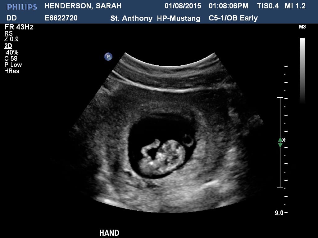 11 Week Ultrasound Pictures