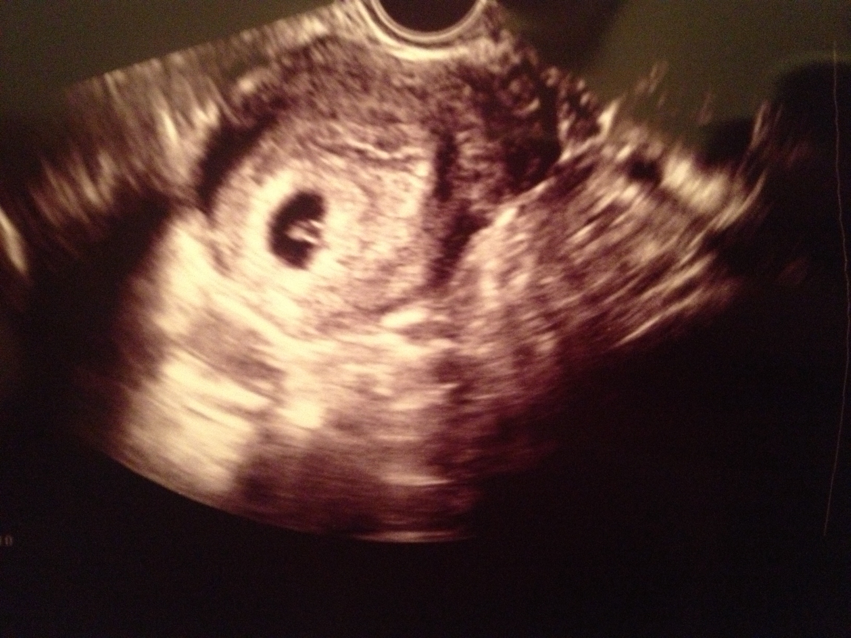 Ramzi Method — The Bump