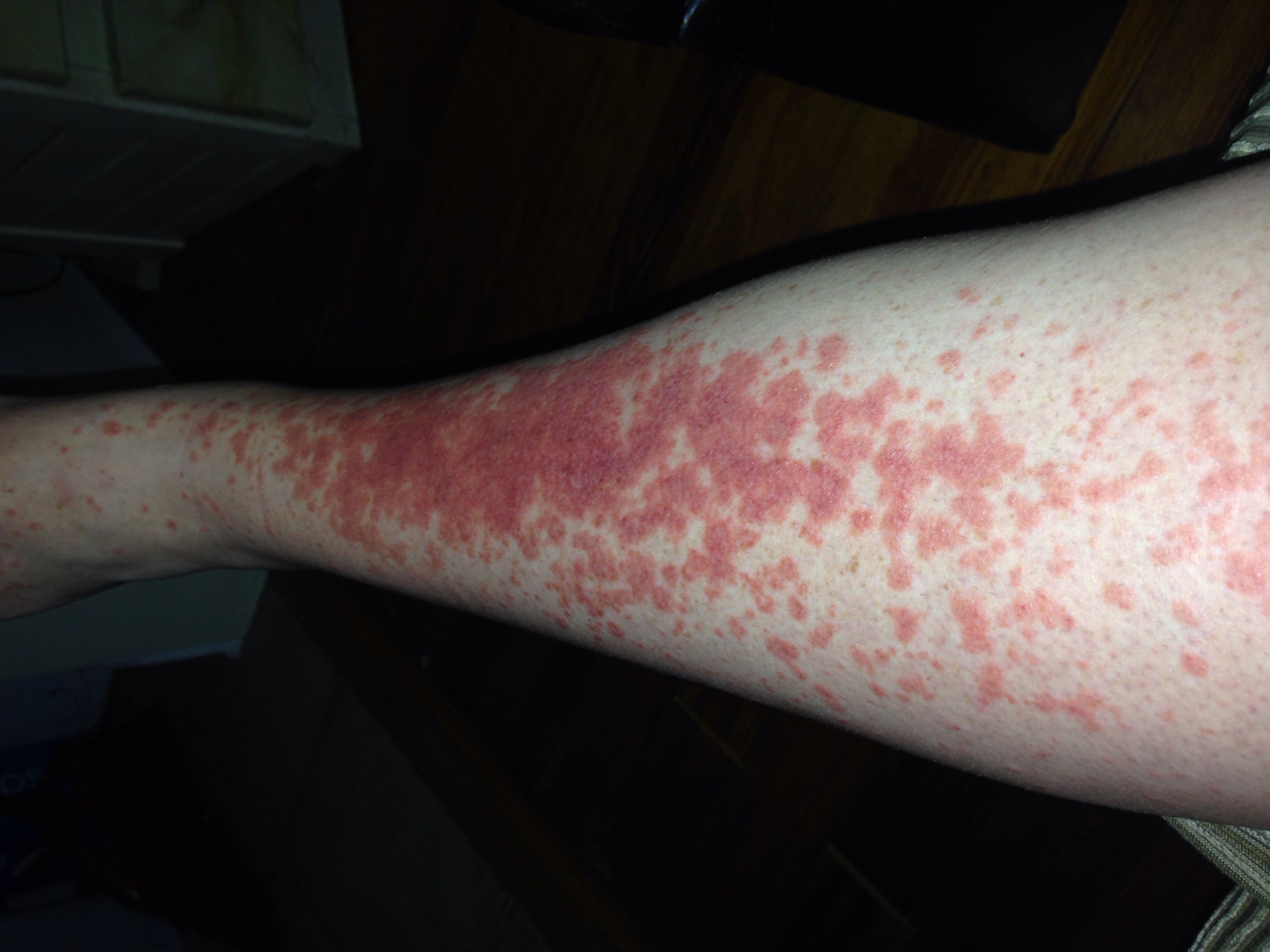 Anyone else have PUPPS? — The Bump