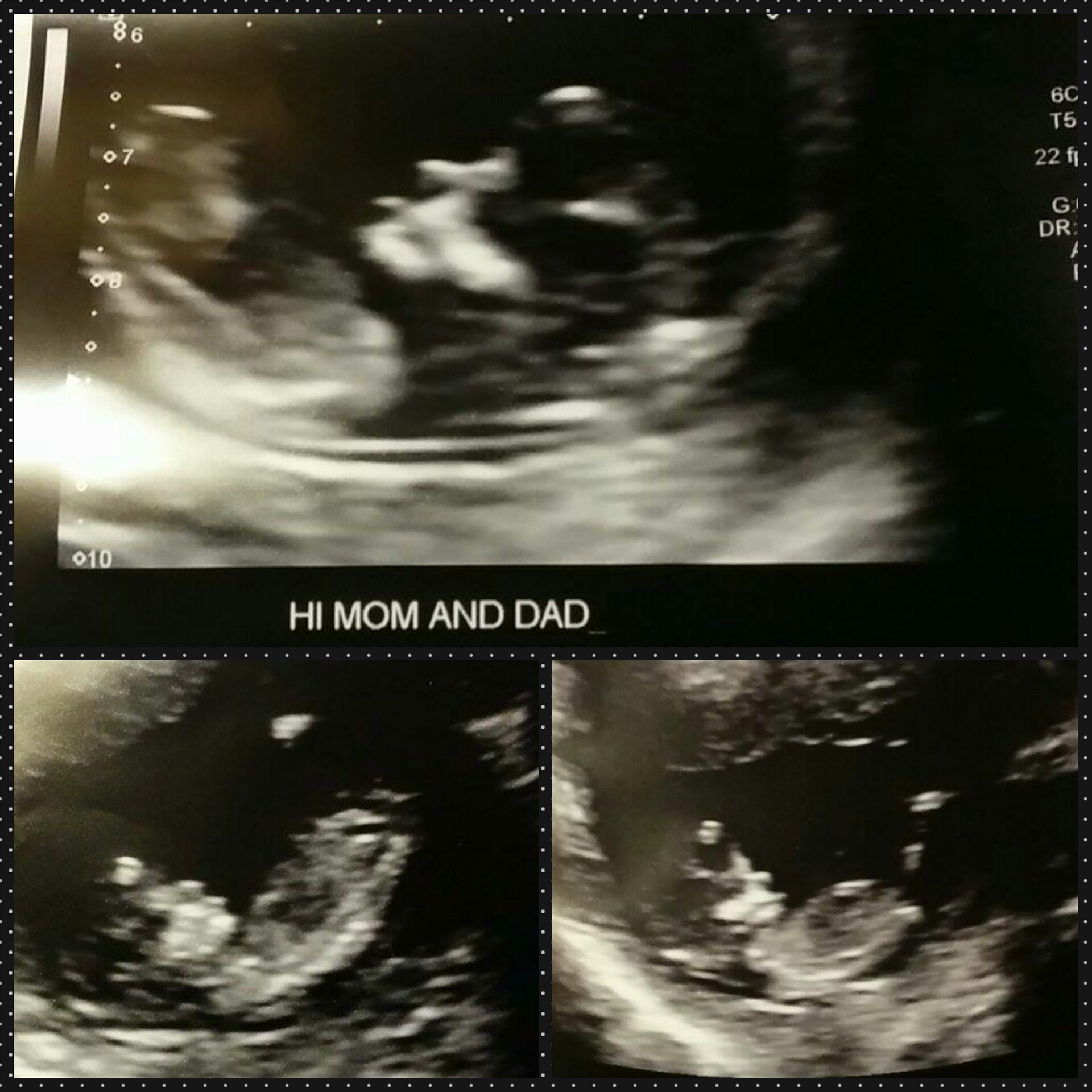12w4d ultrasound — The Bump