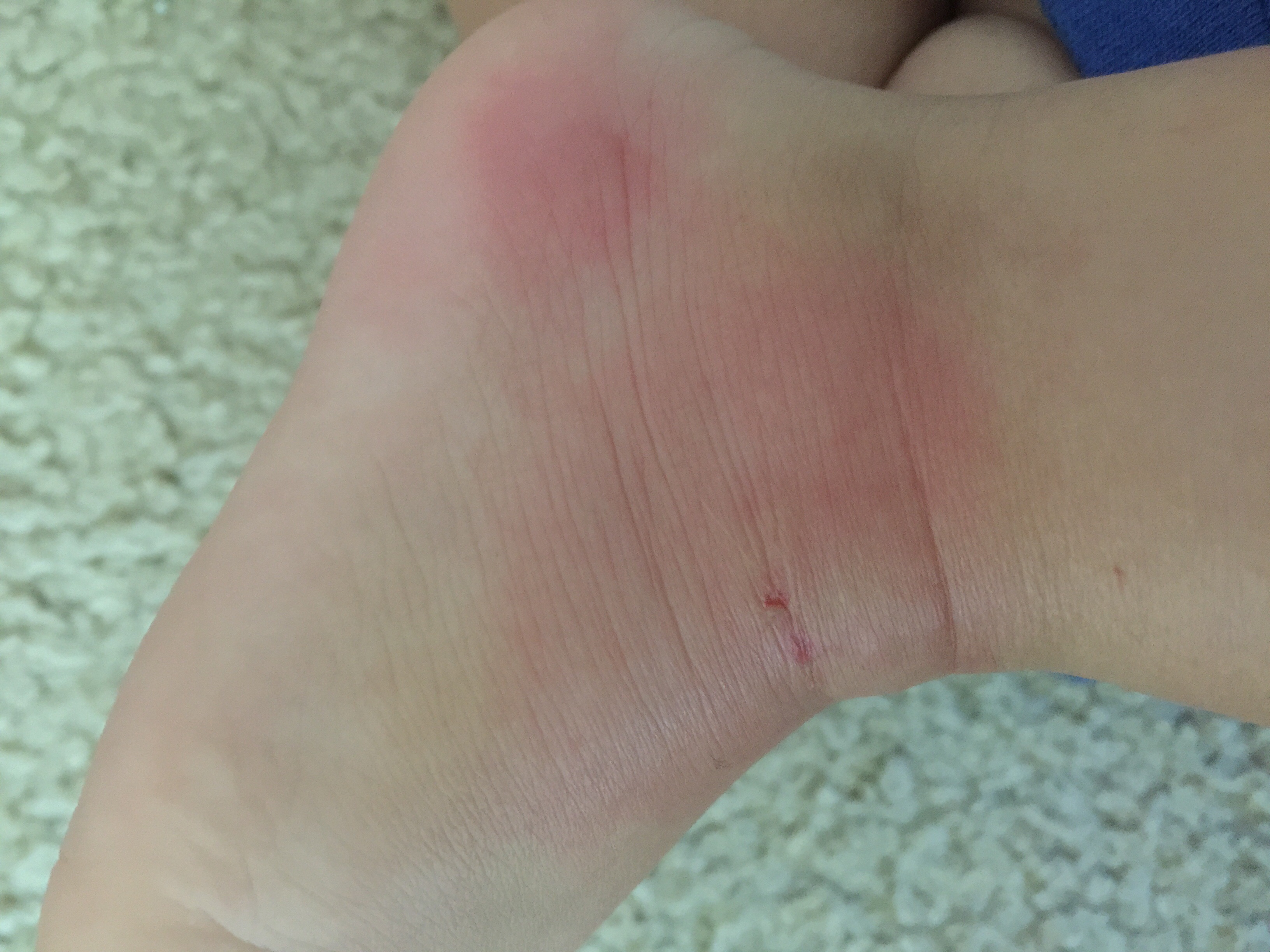 Spider bites? What do you think? — The Bump