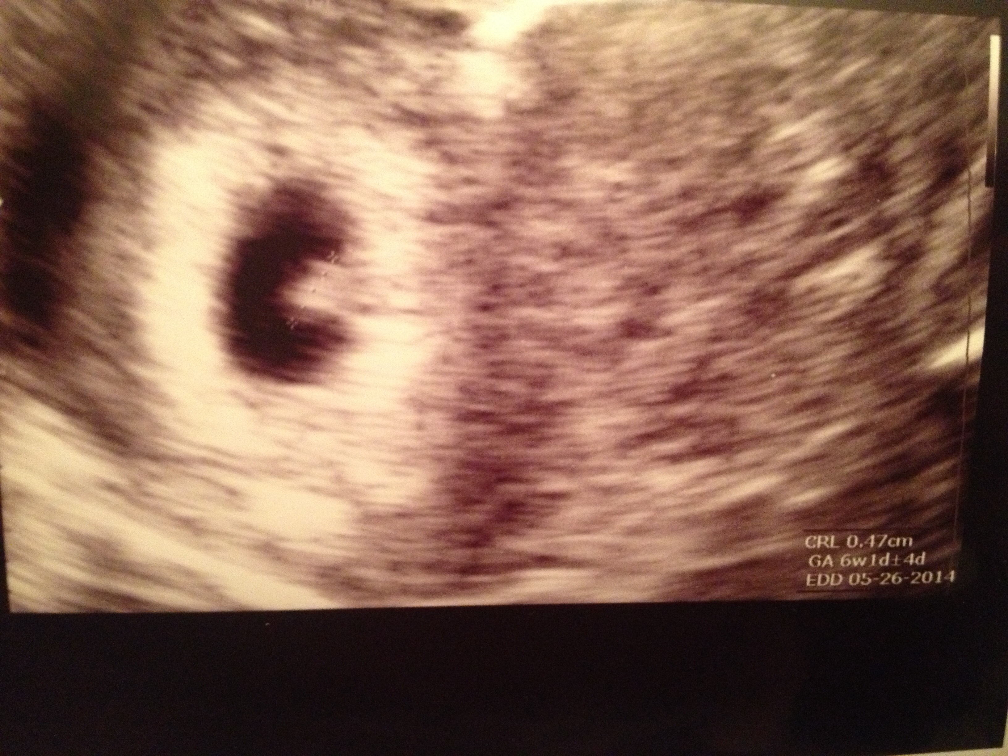 Ramzi Method — The Bump