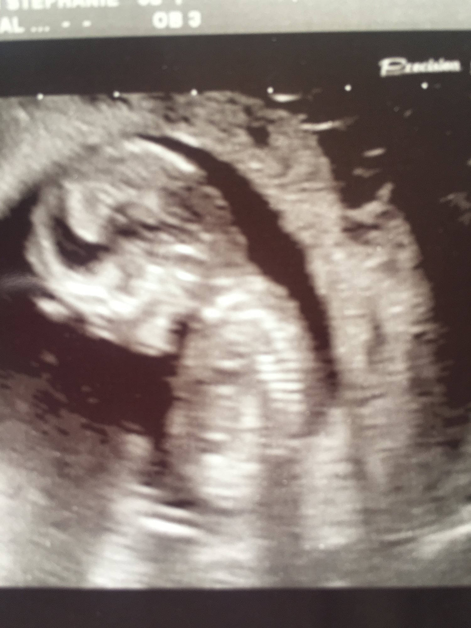 Skull theory? — The Bump