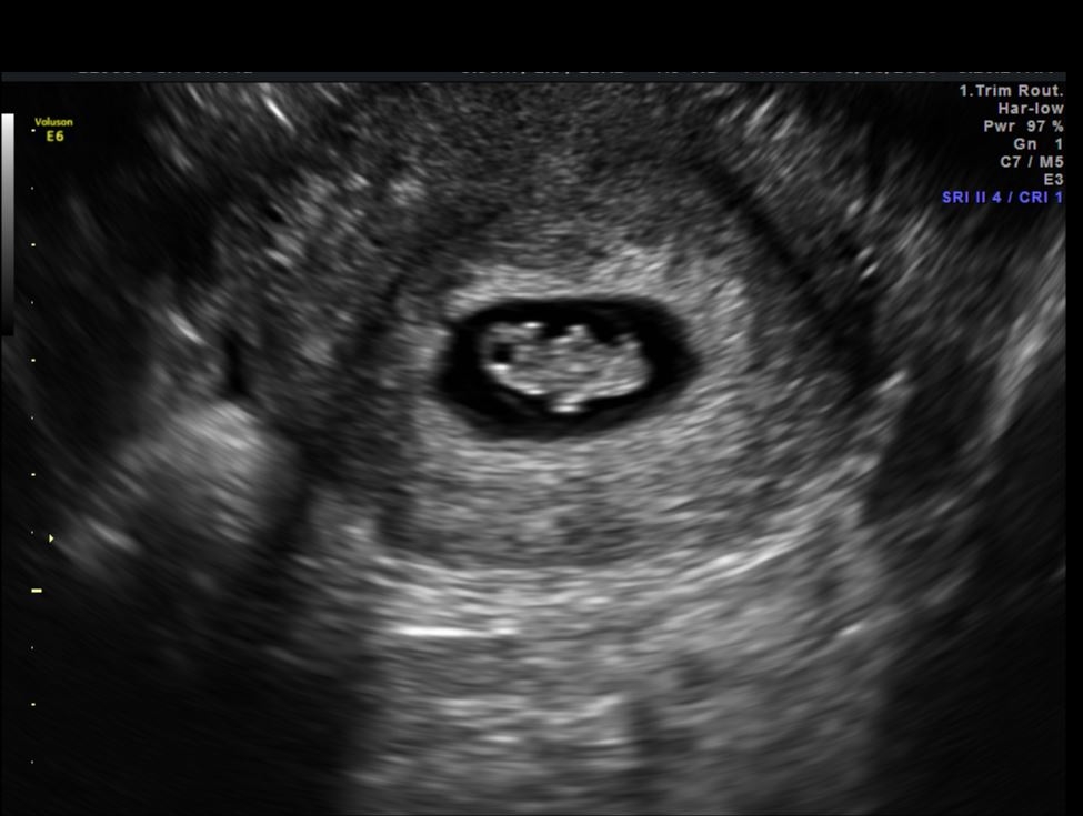 First Ultrasound 7 Weeks 5 Days roughly It Was Transvaginal The Bump