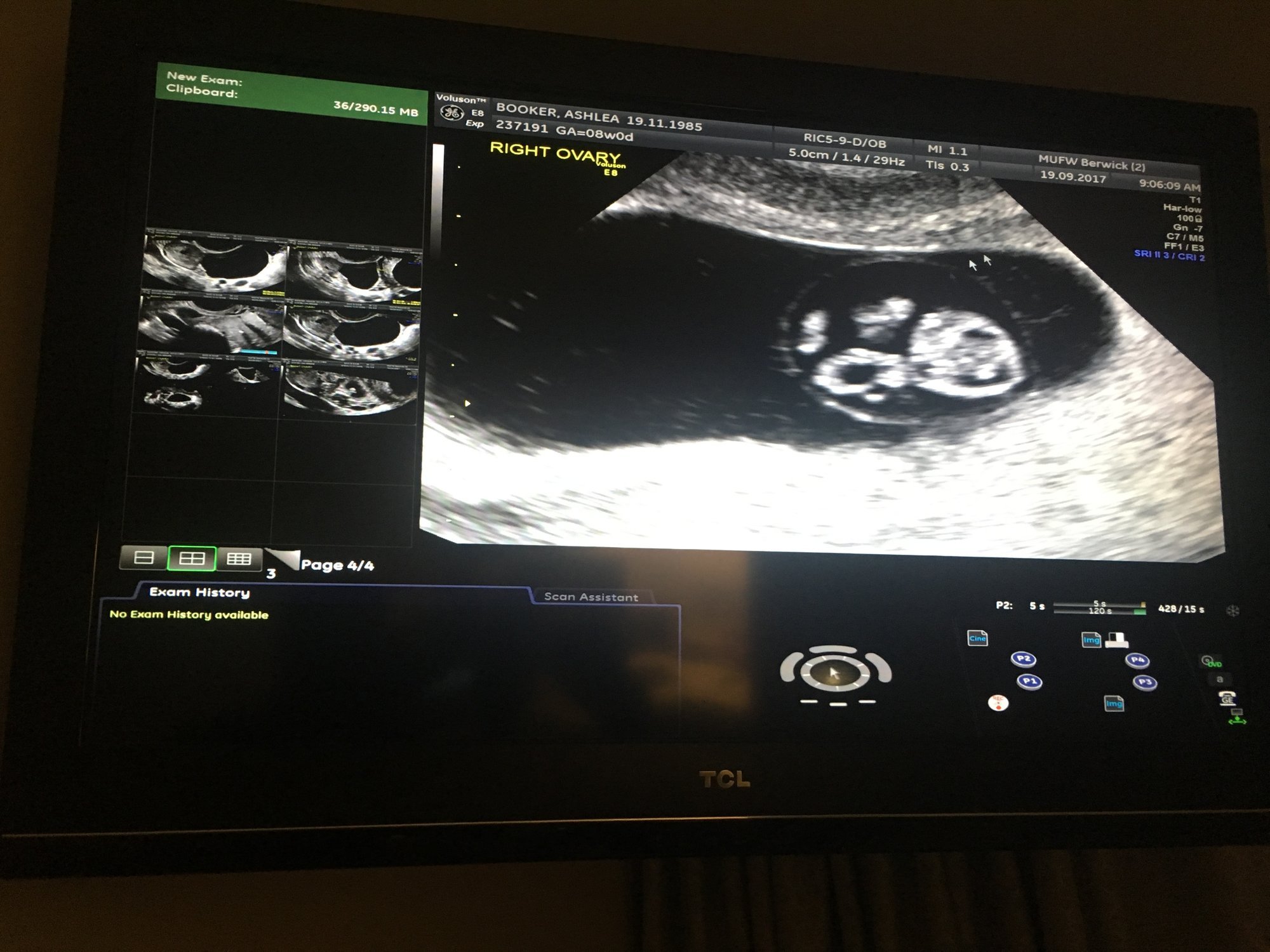 Ultrasound Thread — The Bump