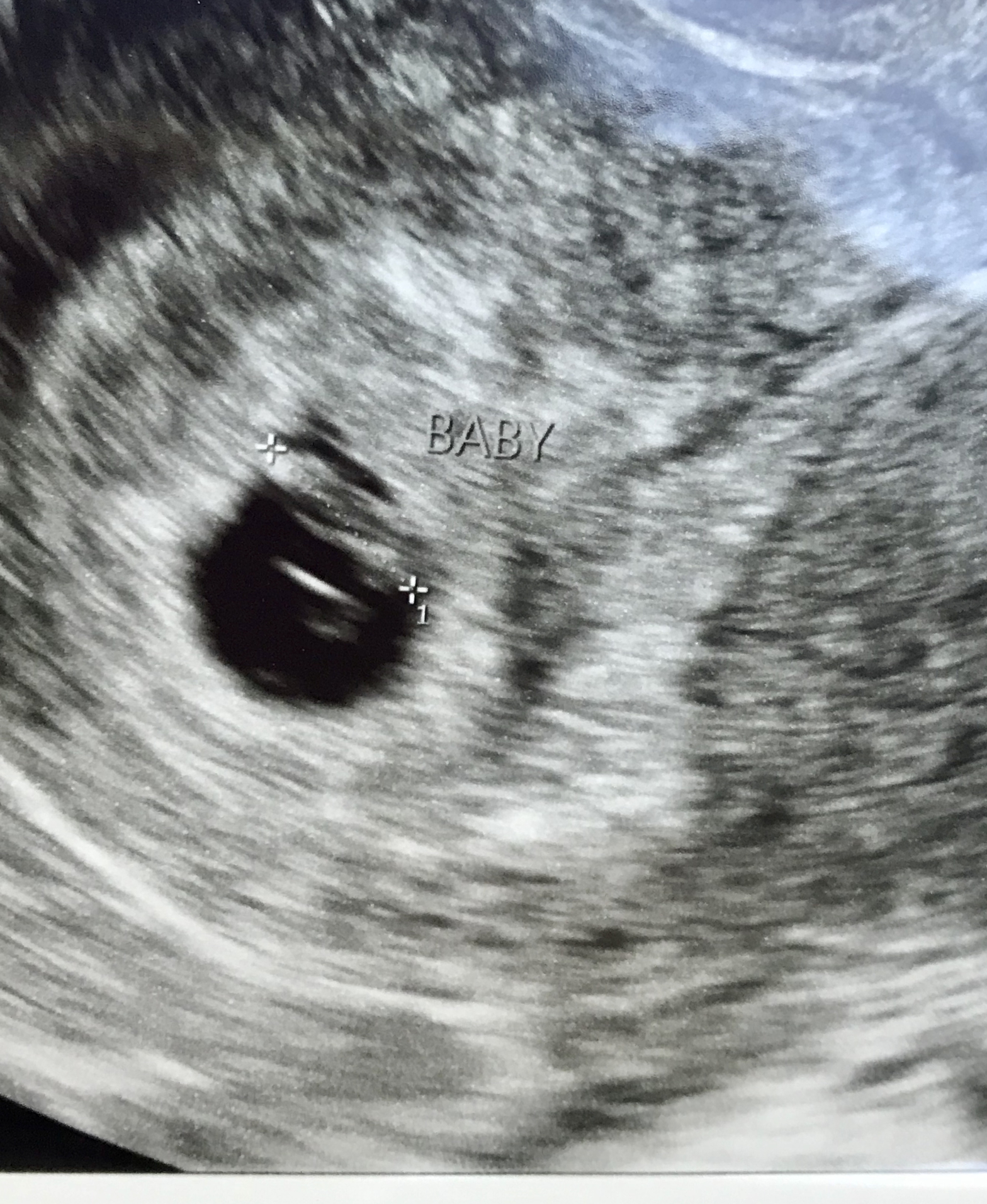 The Ultrasound Thread — The Bump