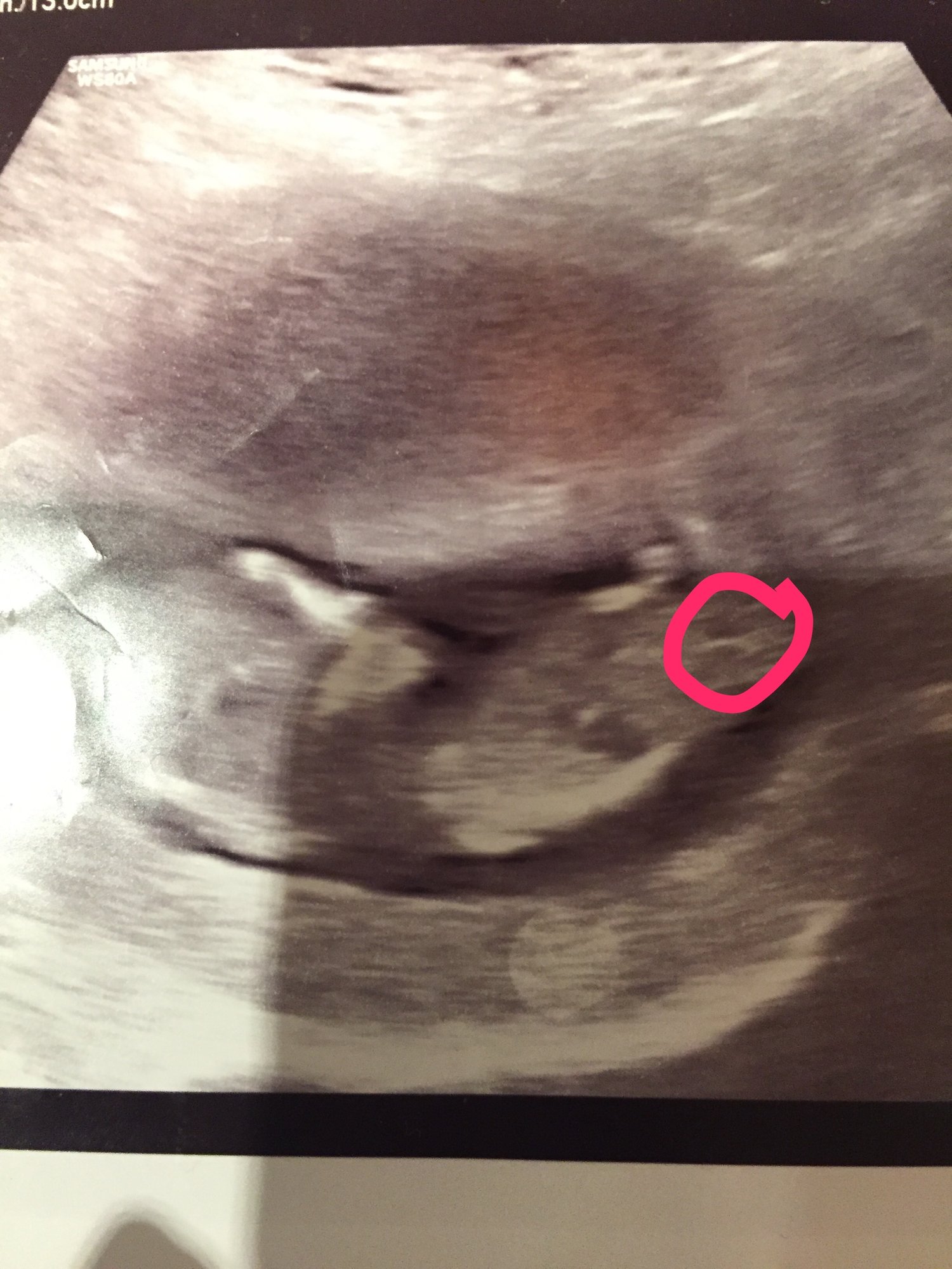 Is that a nub? — The Bump