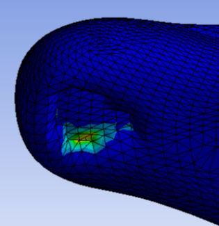 Skin Buckling in Transient Structural Analysis of Foot
