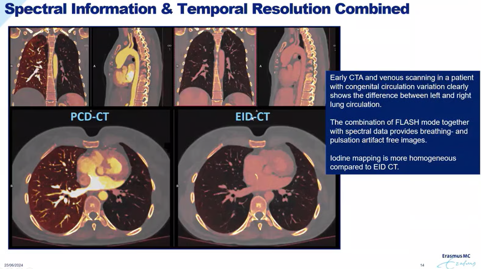 Pediatric chest imaging - NAEOTOM CONNECT
